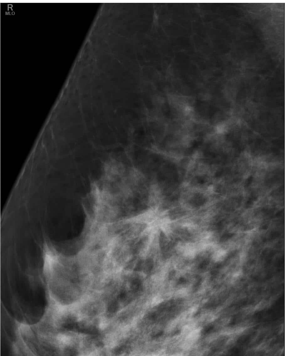 Καρκίνος μαστού - Νίκη Καραγλάνη